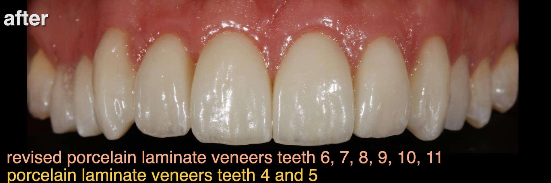Case study: Veneer Therapy