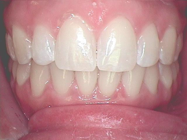 Best Invisalign Treatment in Keller, TX | Dentistry for Life