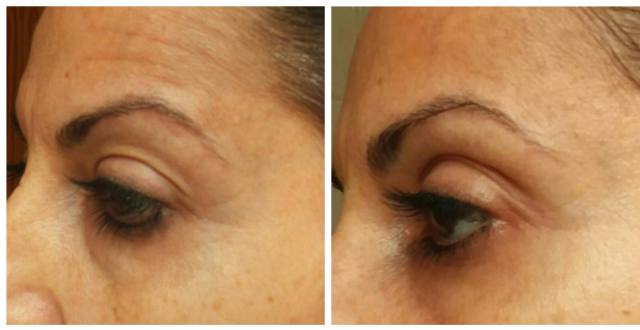 Qué es el aplicador de microcorriente Gtrode y para que sirve